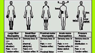 Proximal diabetic neuropathy