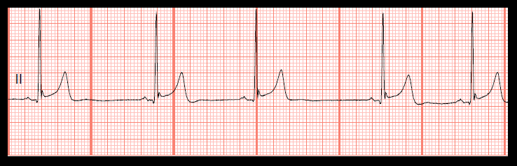 Float Nurse: Basic EKG Rhythm Test 18
