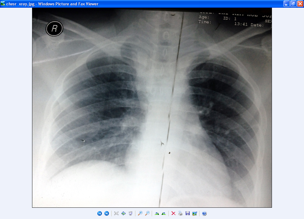 VIETNAMESE MEDIC ULTRASOUND: CASE 290: PARACERVICAL SPINE ABSCESS: Dr ...