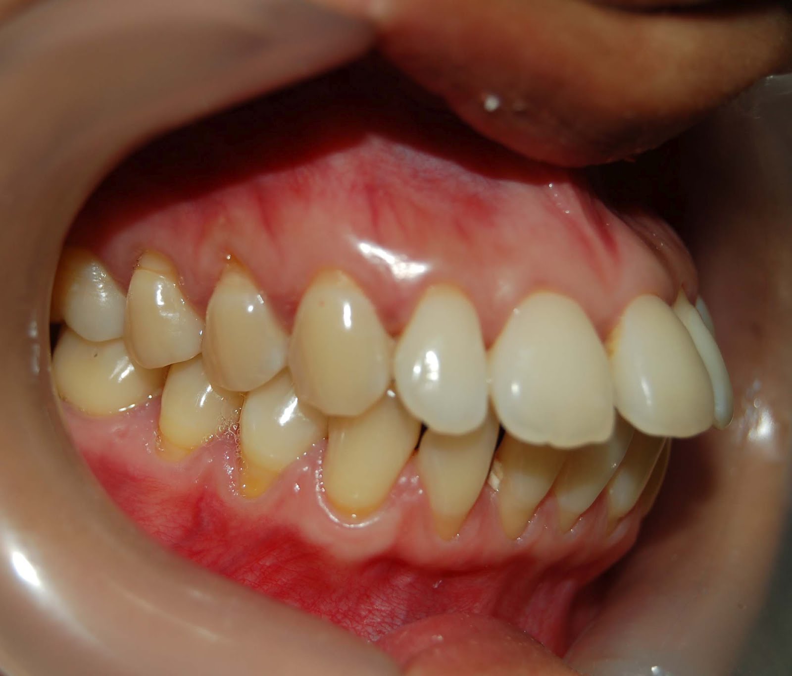 aryabrahmanta: ORTHODONTIC TREATMENT OF CLASS I MALOCLUSION WITH SEVERE ...