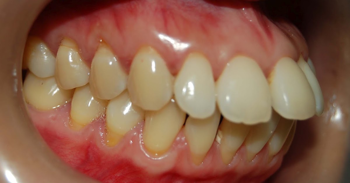 aryabrahmanta: ORTHODONTIC TREATMENT OF CLASS I MALOCLUSION WITH SEVERE ...