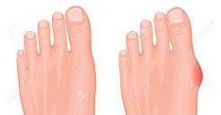 Sabem o que é o Hallux valgus?