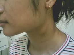 1924 LA BCG VACUNA EFICAZ CONTRA LA TUBERCULOSIS - El Médico en la Casa