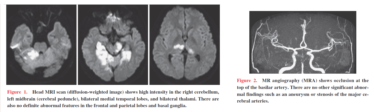 松下 ER ランチ・カンファレンス: Top of the basilar syndrome 脳底動脈先端症候群