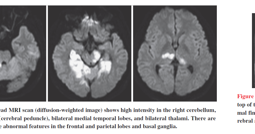 松下 ER ランチ・カンファレンス: Top of the basilar syndrome 脳底動脈先端症候群