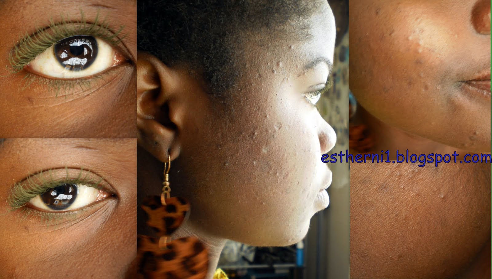 What is the cause of my dirty looking sclera and how ...