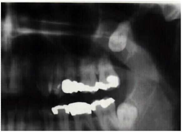 Dentistry and Medicine: Surgical management of Unerupted and Impacted teeth