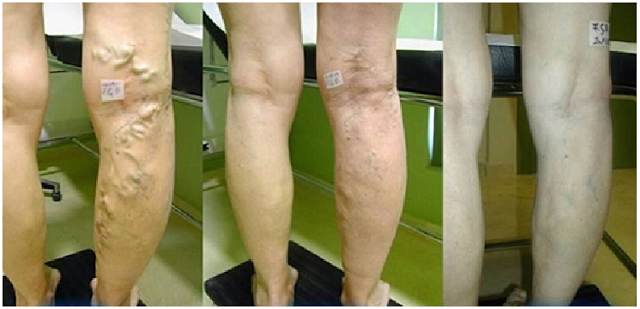 SILAHKAN DICOBA !!! BAGI KALIAN YANG MENDERITA ATAU MENGALAMI VARISES ...