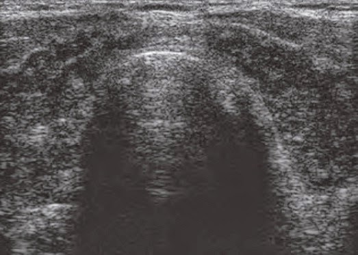 Thyroiditis | Radiology