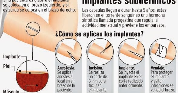 El Implante Subdérmico