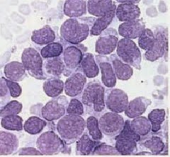 fichero hematologia: Leucemia mieloblastica aguda minimamente ...