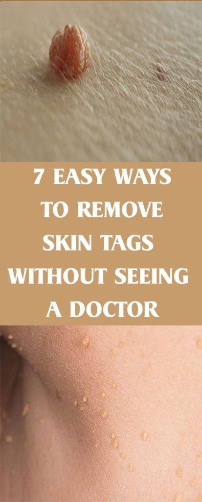 7 Easy Ways To Remove Skin Tags Without Seeing A Doctor - Sweet Oh Joy