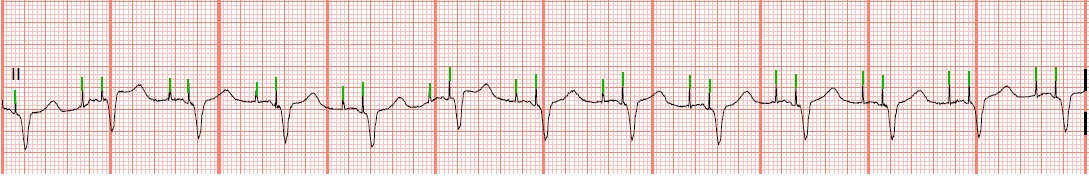 Practice ECG Rhythm Strips 106