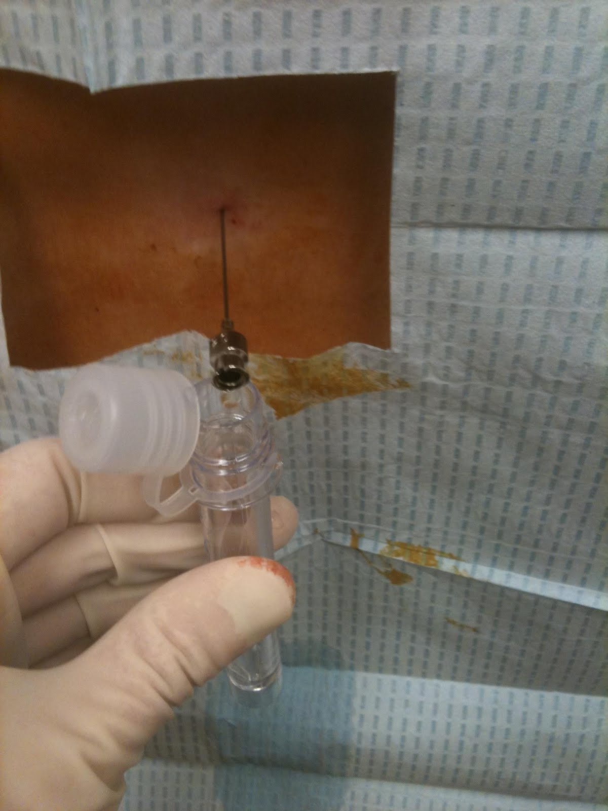 Sleep and Neurology: Lumbar Puncture