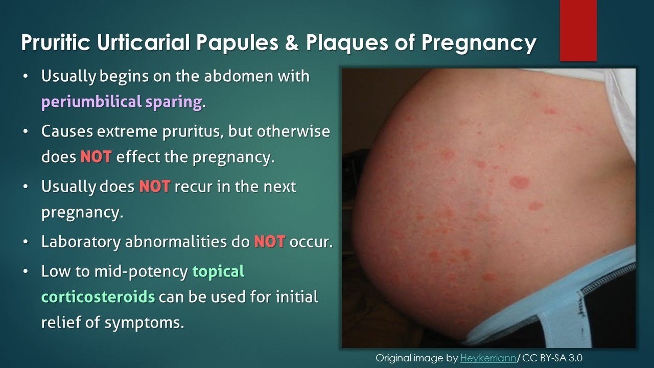 Pruritic urticarial papules and plaques of pregnancy