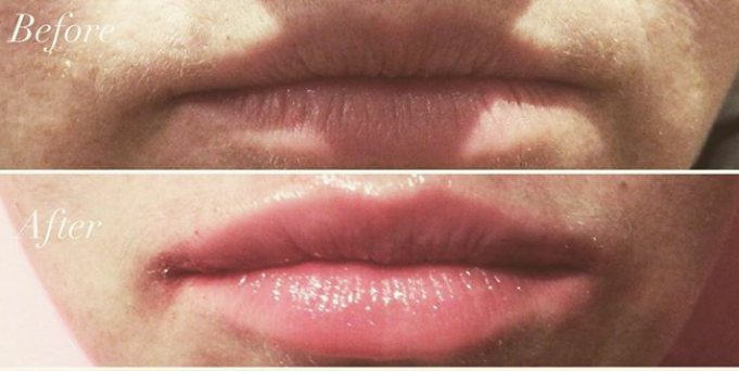 Selston Cosmetic Clinic: Dermal Fillers To Create Natural Looking Lips ...