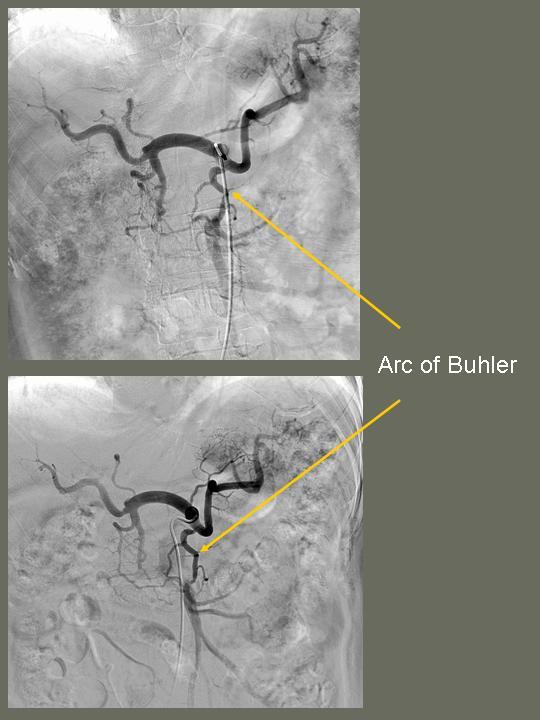 The Pump and the Tubes: Arc of Buhler