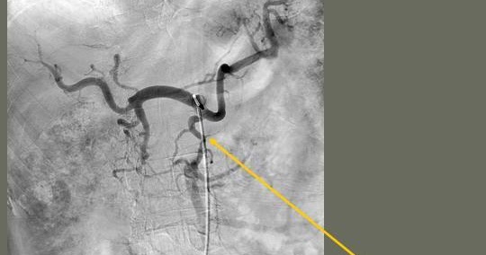 The Pump and the Tubes: Arc of Buhler