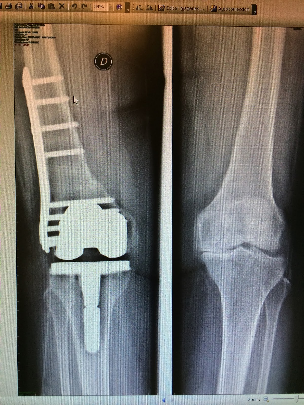 Traumatología y Cirugía Ortopédica: RODILLA