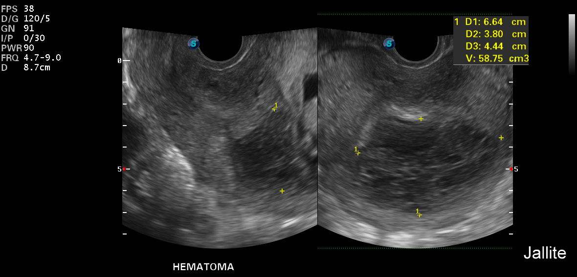 Hematoma Placentario