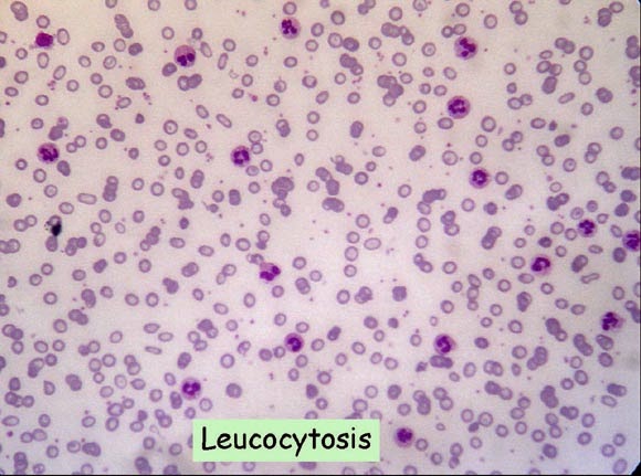 FICHERO DE HEMATOLOGÍA: ANORMALIDADES LEUCOCITARIAS. Cambios en el ...
