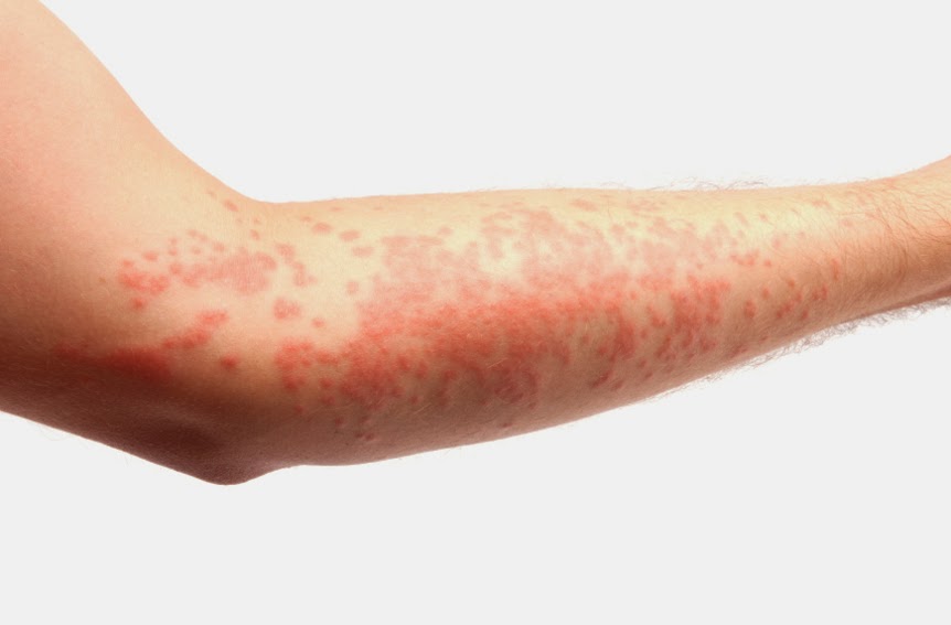 Allergic Contact Dermatitis Treatment | Health And Beauty