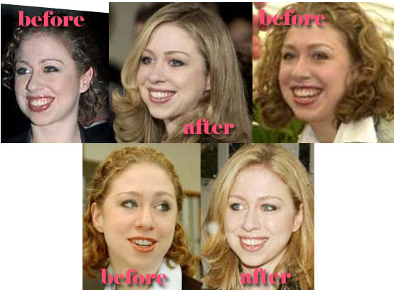 Chelsea Clinton Plastic Surgery Before and After Nose Job and Chin ...