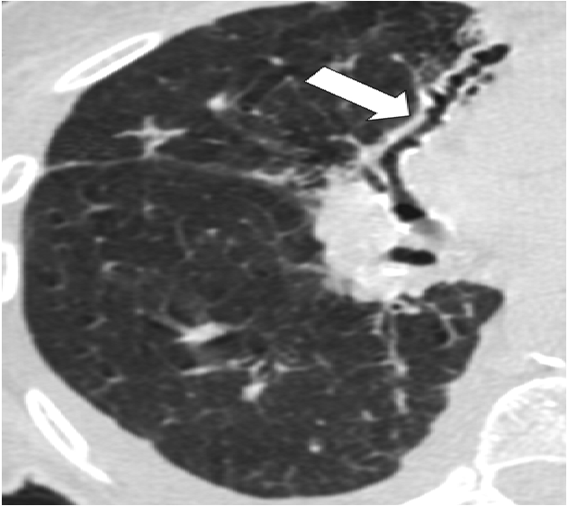 Chest Medicine Made Easy-Dr Deepu: The HRCT findings of Bronchiectasis.
