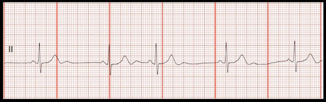 Practice EKG Rhythm Strips 126
