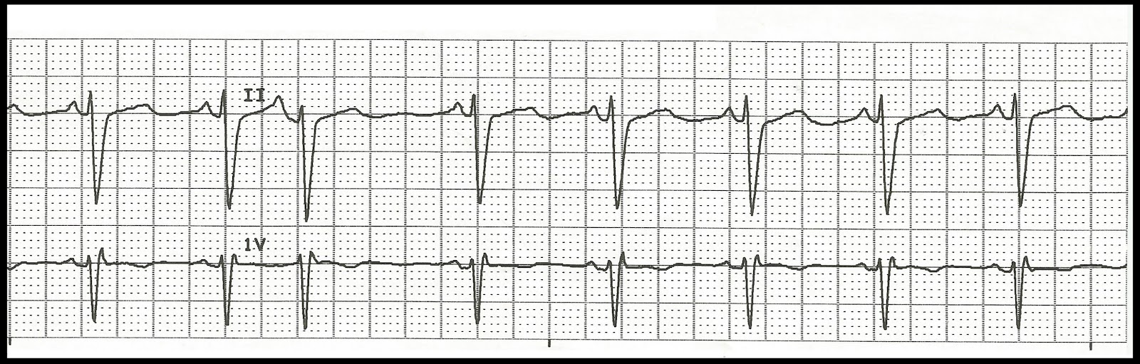 Practice EKG Rhythm Strips 162