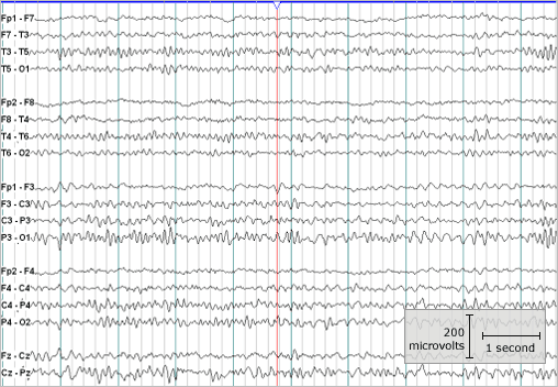 Teknologi Kesehatan: ELECTROENCHEPHALOGRAM (EEG)