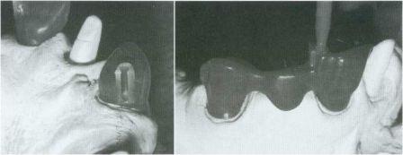 Konektor GTJ | SERBA SERBI DENTISTRY