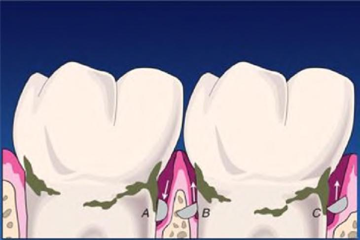 Dentistry lectures for MFDS/MJDF/NBDE/ORE: PRINCIPLES OF ...
