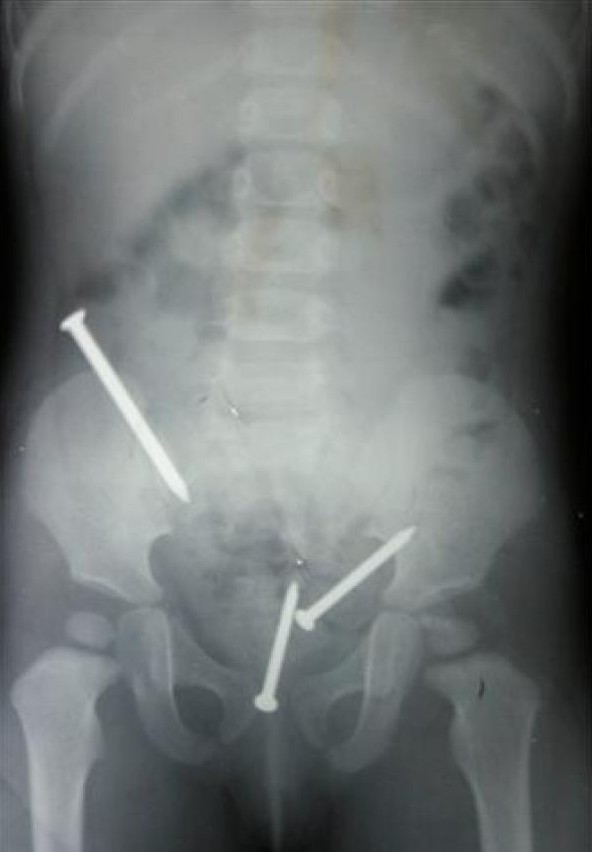 Deformutilation: Disturbing X-Rays