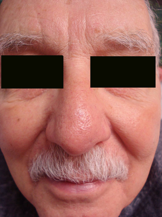 VIRTUAL GRAND ROUNDS IN DERMATOLOGY 2.0: The Rudolph Sign