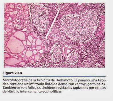 Portafolio Patología B: TIROIDITIS