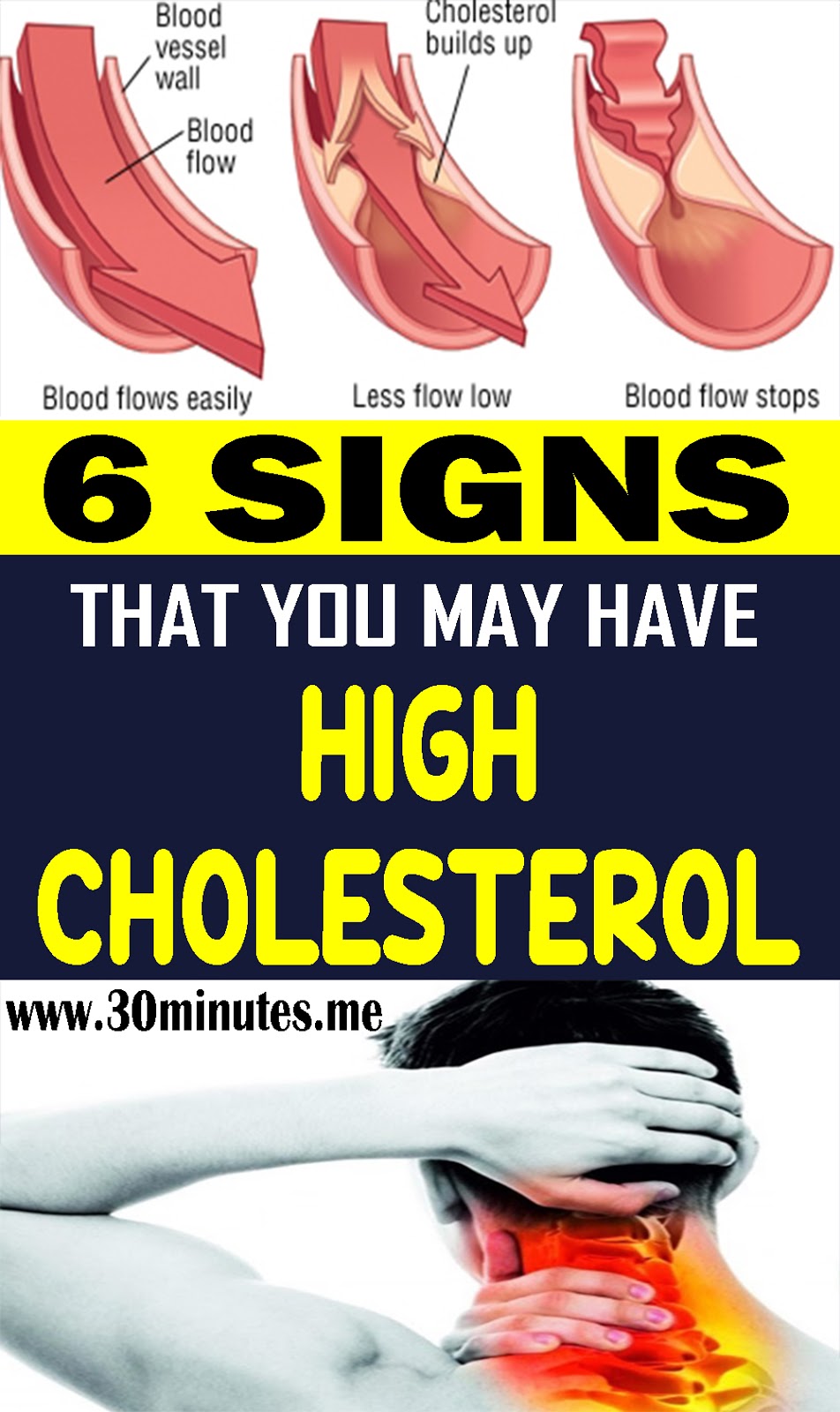 6 Signs That You May Have High Cholesterol - Health Fitness Tips