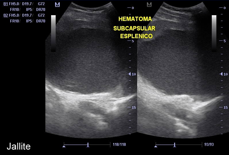 Hematoma Subcapsular Esplenico
