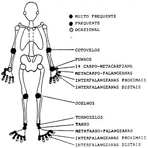 Dr. Deo de Freitas: DOENÇA CHAMADA GOTA ou "Doença dos Reis"