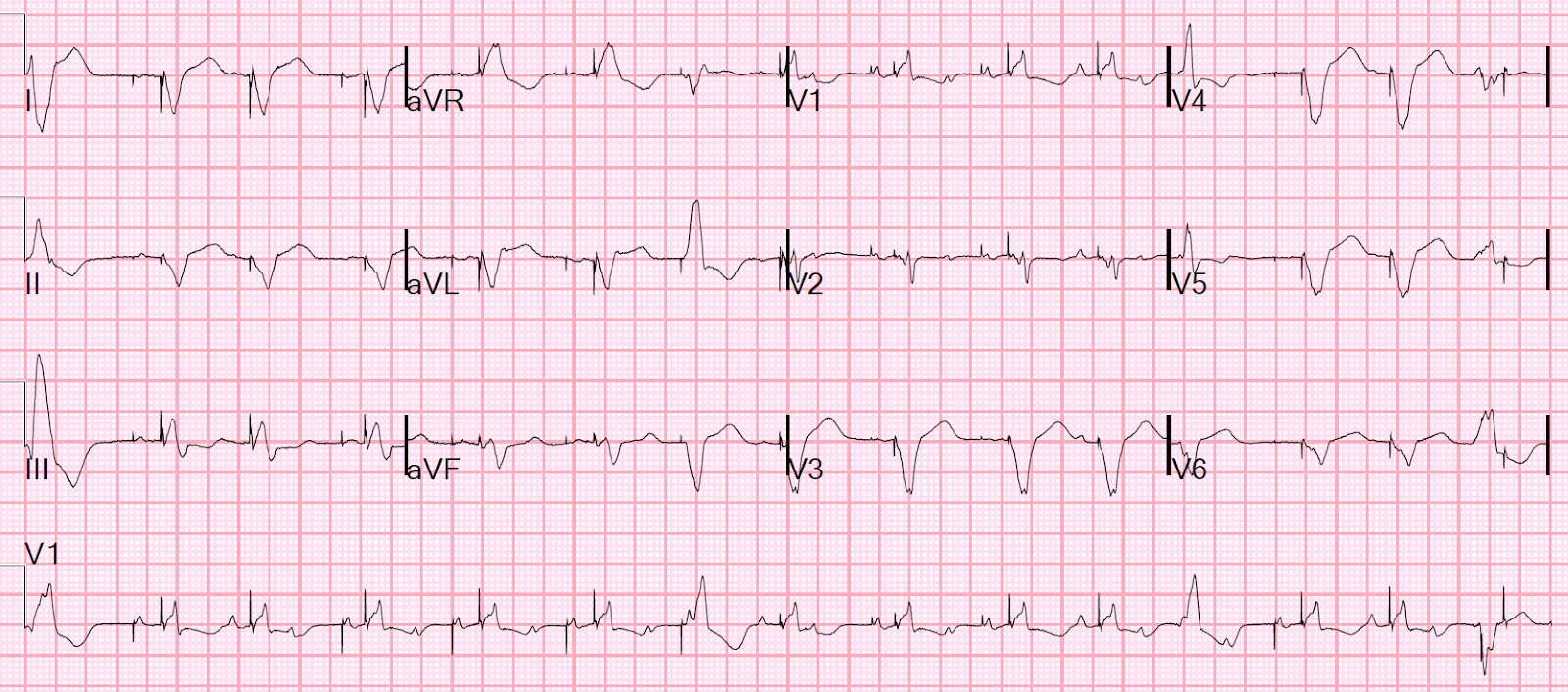 Dr. Smith's ECG Blog: Acute chest pain in a patient with cardiomyopathy ...