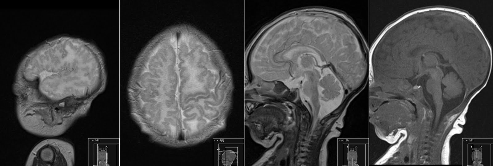 Congenital Cytomegalovirus Infection