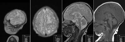 Congenital Cytomegalovirus Infection - Radiology Imaging