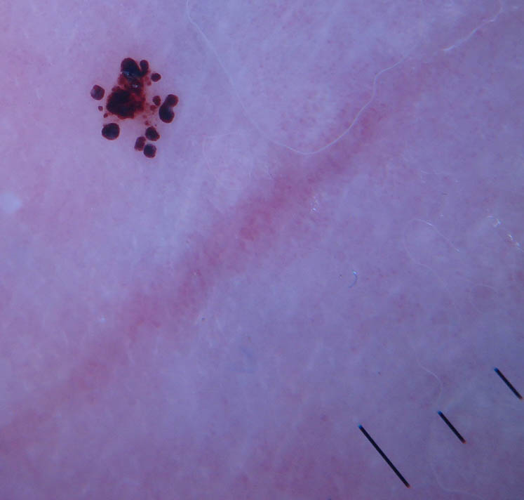 VIRTUAL GRAND ROUNDS IN DERMATOLOGY 2.0: Dermoscopy Rocks