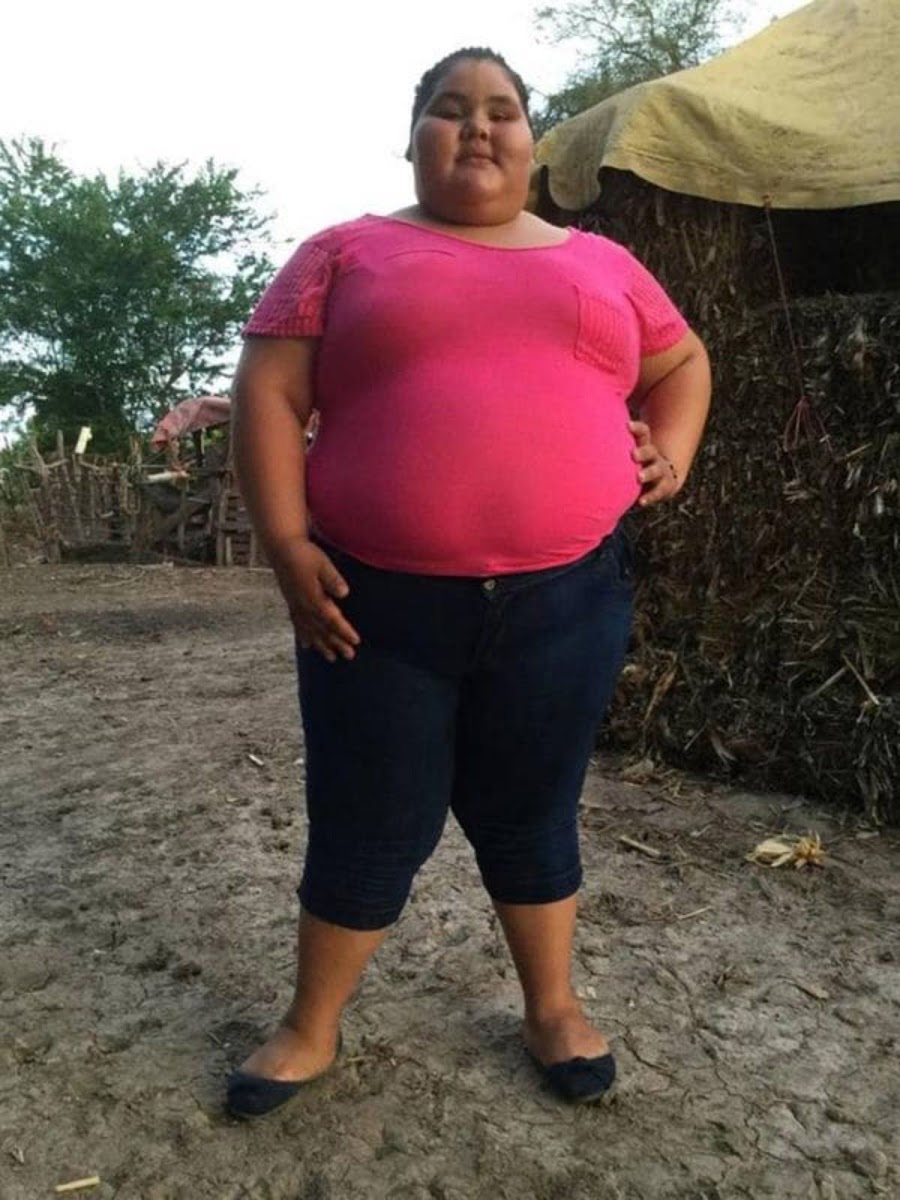 IncreÍble AsÍ Luce La NiÑa Mas Gorda Del Mundo PerdiÓ 90 Kilos