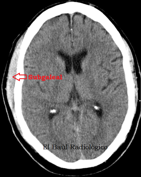 El Baúl Radiológico: 2) HEMATOMA SUBGALEAL: HALLAZGOS EN TOMOGRAFÍA ...