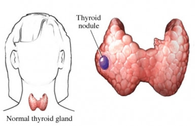 10,000 Strong Against Thyroid Cancer: Thyroid Nodules Overview