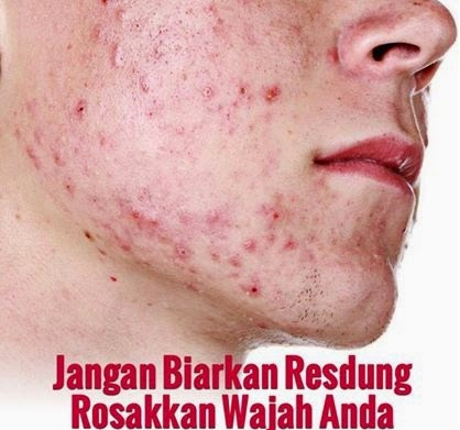 Cara hilangkan penyakit resdung paling berkesan supaya boleh makan ...