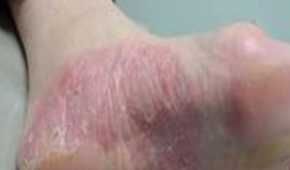 Perfect Athlete's Foot Treatment, Causes & Symptoms - NikiHow