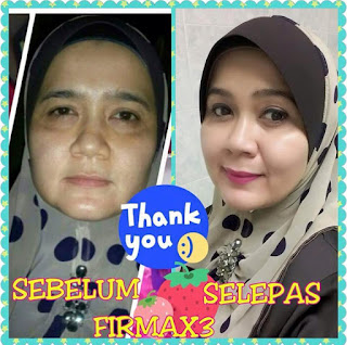 firmax3: Transformasi Wajah setelah menggunakan CREaM FIRmax3 + Serum ...