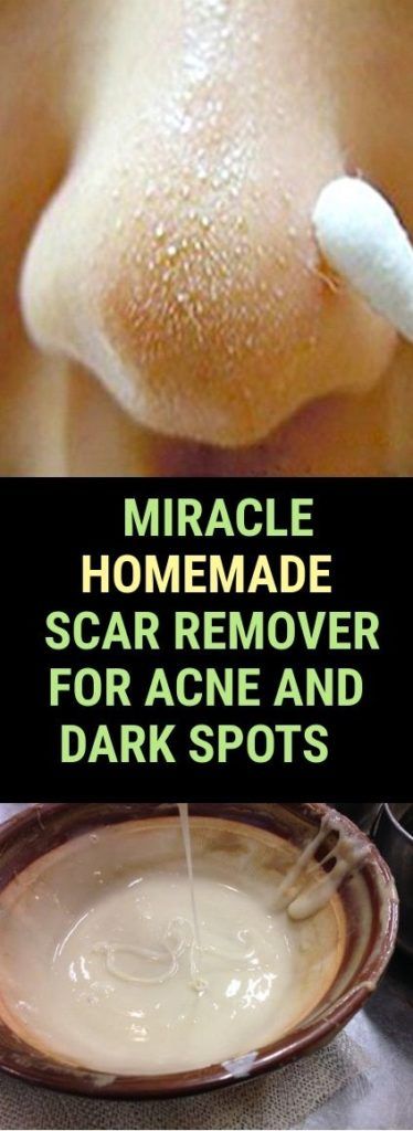 Miracle Homemade Scar Remover For Acne And Dark Spots - HEALTH RECIPES